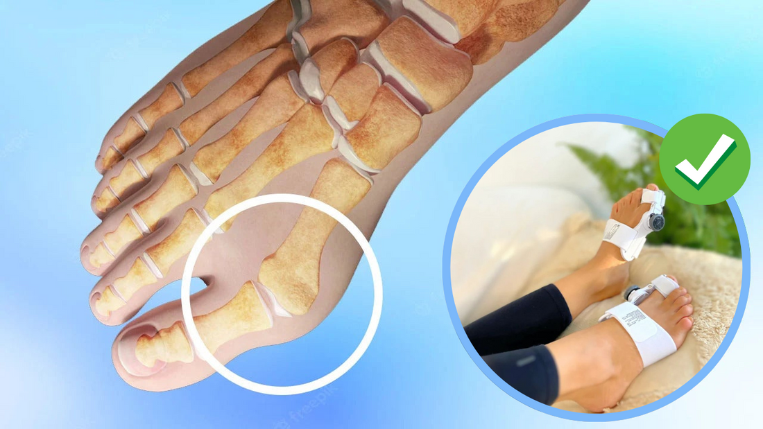 Vidéo Explicative - Comment utiliser l'orthèse d'hallux valgus – Semello.fr